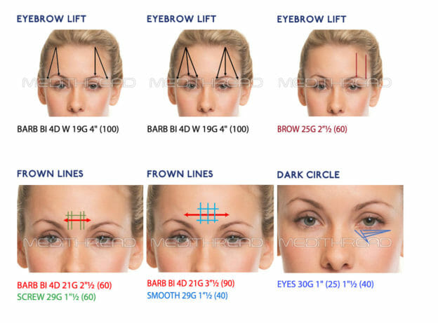 The Transformative Power Of Eyebrow Lifts With PDO Threads - SF Plastic ...
